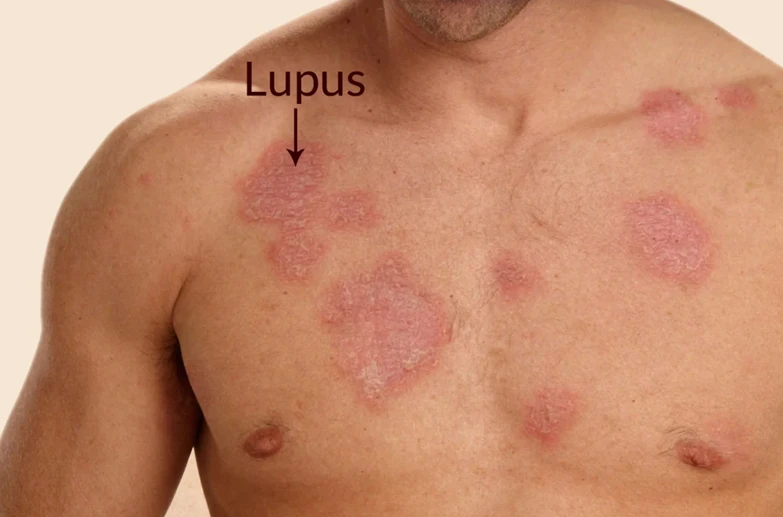 Kebotakan: Penyebab, Jenis, dan Cara Mengatasinya Sebelum Terlambat!