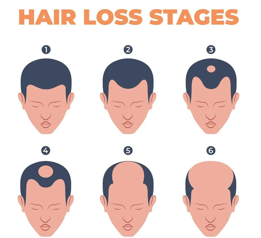 Kebotakan: Penyebab, Jenis, dan Cara Mengatasinya Sebelum Terlambat!